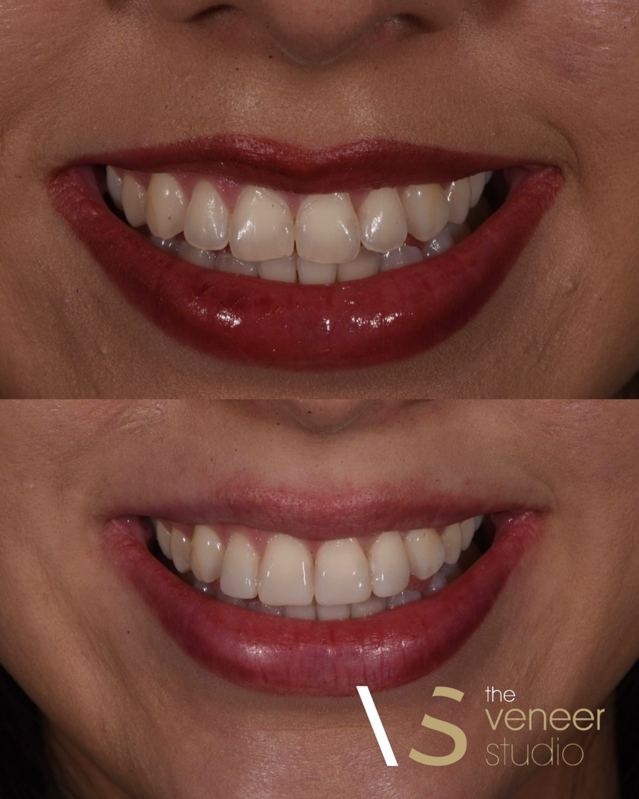 Composite Veneers Melbourne - Get Composite Resin Treatment